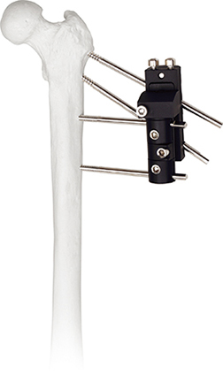 Orthopedic Orthofix Pertrochanteric External Fixators for Femur with CE ...