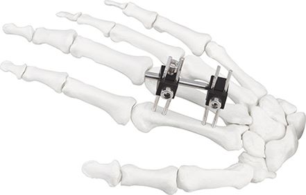 Orthofix Mini Universal Type External Fixators for Finger Orthopedic ...