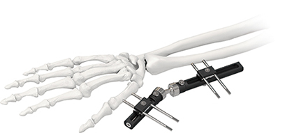 Orthofix Wrist External Fixators Standard Type with High Quality from ...