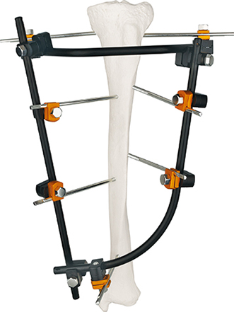 Jinlu Medical orthopedic tibial joint side external fixator for distal ...