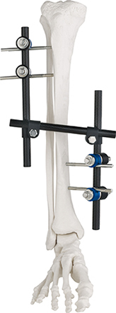 AO Design Combinational Z Type External Fixators for Femur&tibia ...