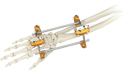 Hoffman Design Combinational Ulna&Radius Spanning External Fixators ...