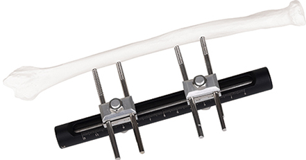 Orthofix Forearm External Fixators for Orthopedic Fixation witnCE from ...
