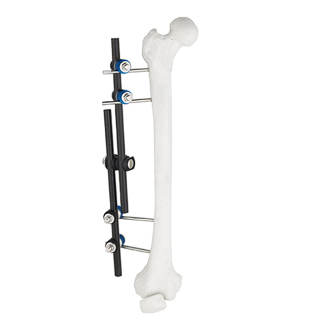 AO Design Combinational Straignt Type External Fixators for Femur ...
