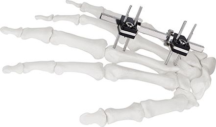 Orthofix Mini Straight Type External Fixators for Finger Orthopedic ...
