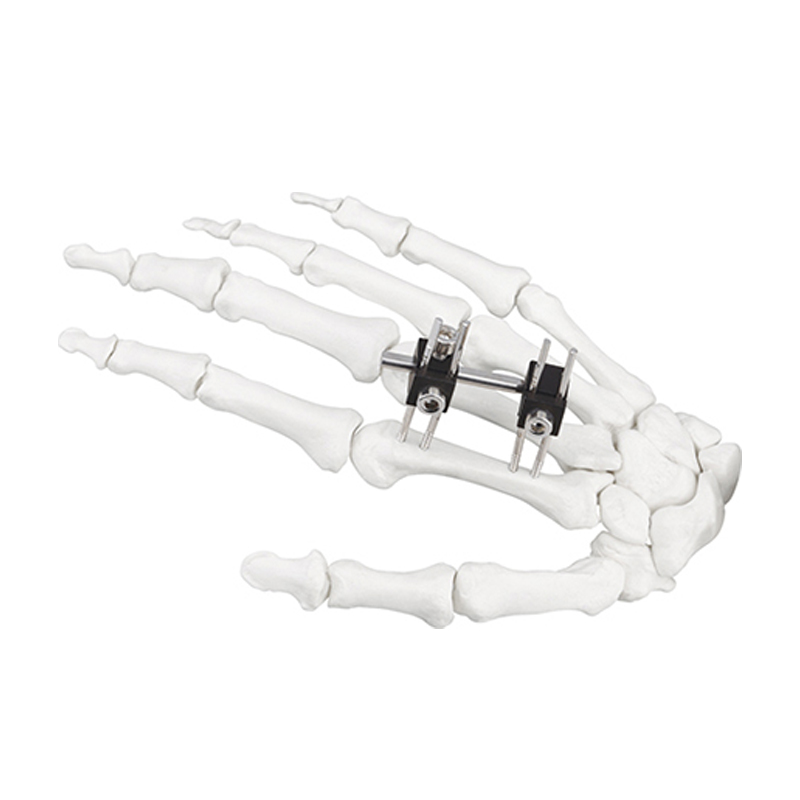 Jinlu Medical orthopedic bone fracture Mini fixator universal type for ...