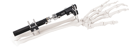 Orthofix Wrist External Fixators（L type） for Orthopedic Fixation from ...