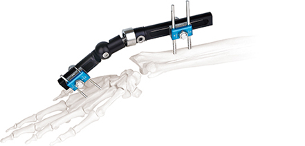 Orthofix Wrist External Fixators(Half Ball Connection Type) for ...