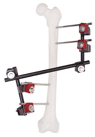 Jinlu Medical Chinese factory orthopedic bone fracture universal pin ...