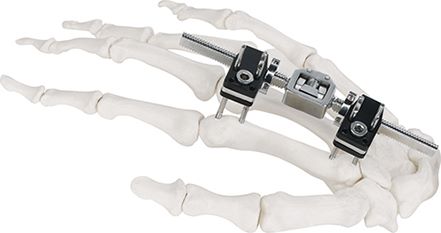 Orthofix Mini JonitMotion Type External Fixators for finger Orthopedic ...