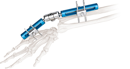 Orthofix Wrist External Fixators（Single Locking Type） for Orthopedic ...