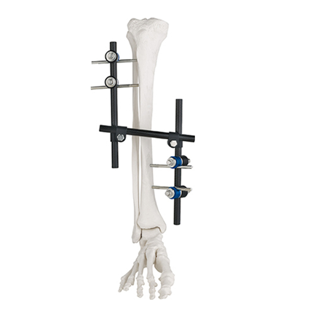 AO Design Combinational Z Type External Fixators for Femur&tibia ...